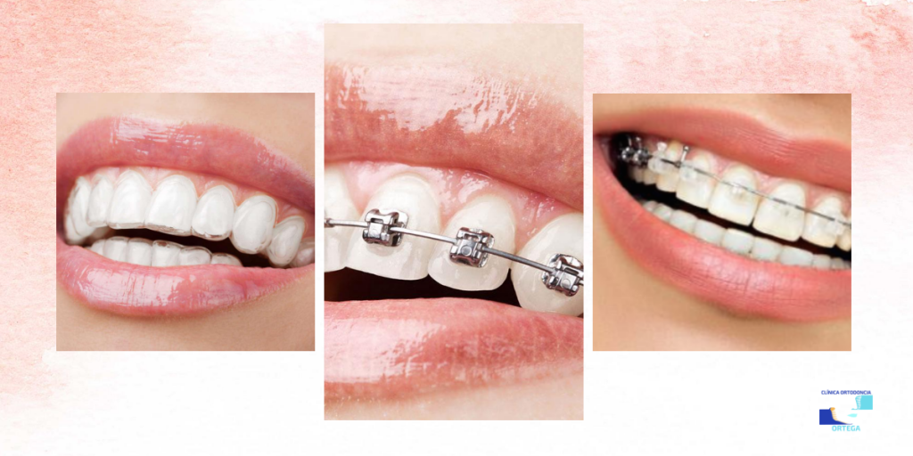 ¿Qué tipos de brackets existen y cuáles son sus diferencias? | Clínica ...