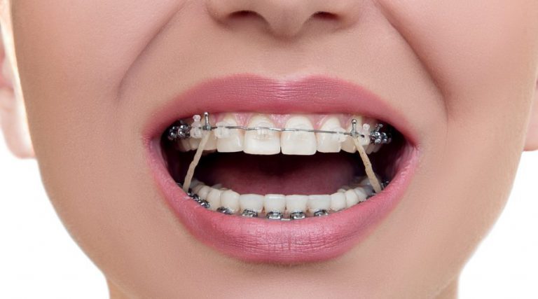 Elásticos intermaxilares en ortodoncia, ¿qué son? | Clínica Ortodoncia ...