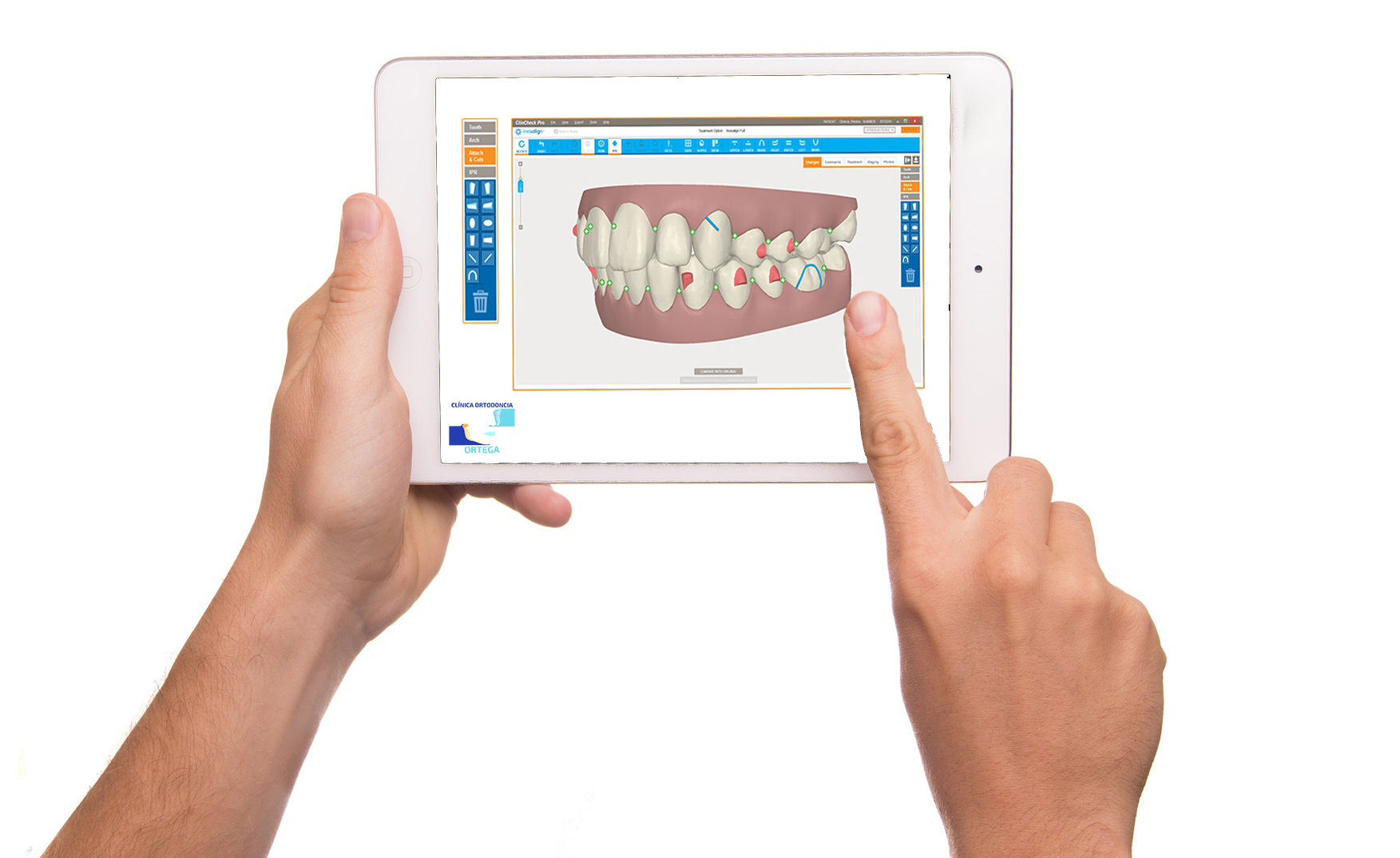 ClinCheck de Invisalign, el futuro de la ortodoncia | Clínica ...