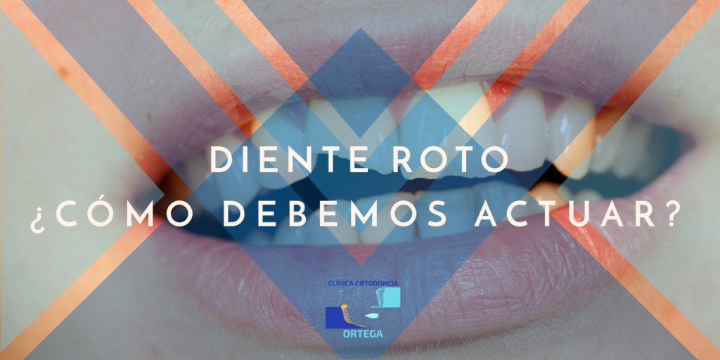 Diente roto, ¿cómo debemos actuar? | Clínica Ortodoncia Arturo Ortega